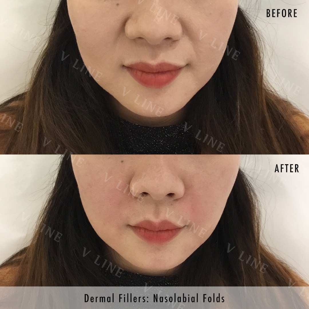 Dermal Fillers Before & After Photos | V Line Cosmetic Center