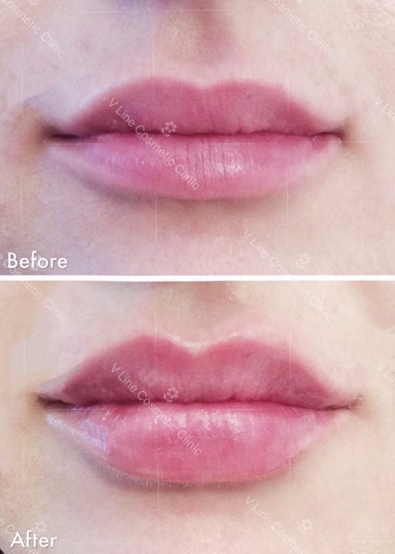 Dermal Fillers Before & After Photos | V Line Cosmetic Center