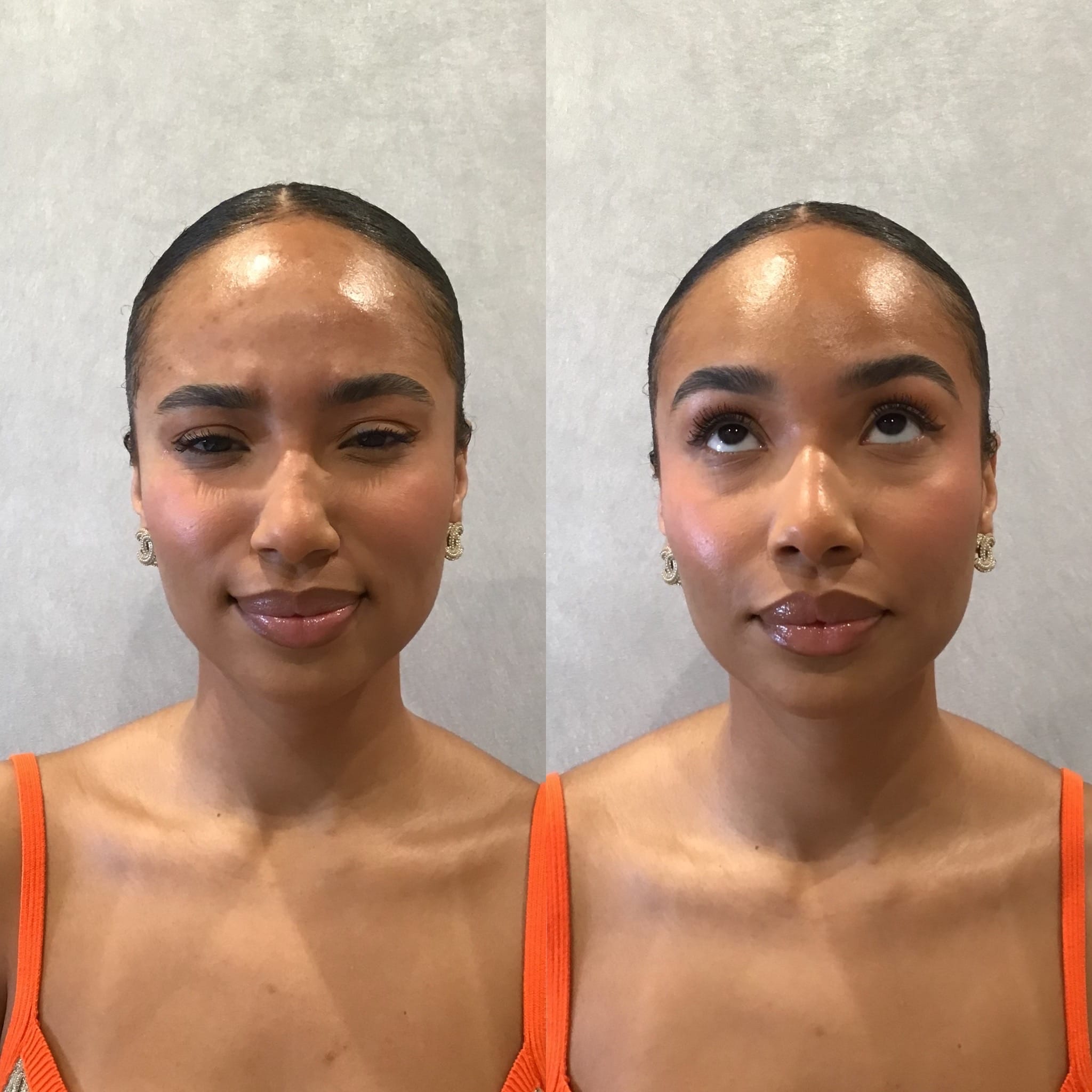Wrinkle Relaxers Before & After Photos | V Line Cosmetic Center